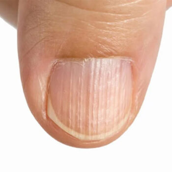 Kidney Disease Nails: How Kidney Disease Affects Your Nails
