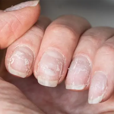 Images Of Nails With Kidney Disease What Discoloration Of The Nail