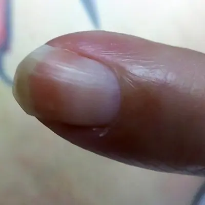 Images Of Nails With Kidney Disease What Discoloration Of The Nail