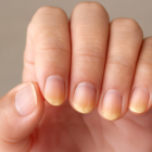 Kidney Disease Nails: How Kidney Disease Affects Your Nails