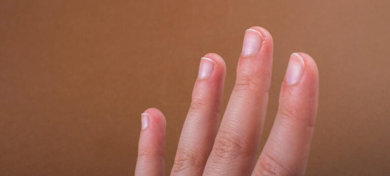 Kidney Disease Nails: How Kidney Disease Affects Your Nails