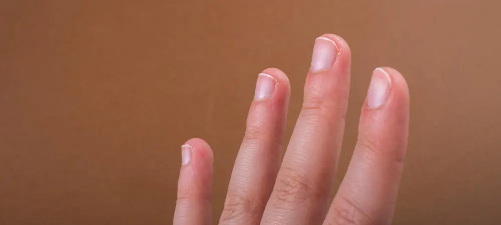 Kidney Disease Fingernails Nail Diseases Skin Health Institute