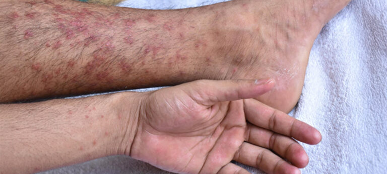 Early-Stage Kidney Disease Rash: Causes, Symptoms, and More