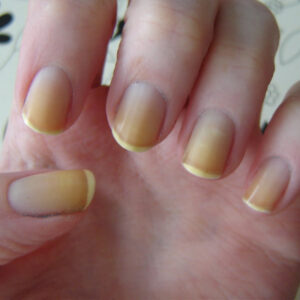 Kidney Disease Nails: How Kidney Disease Affects Your Nails